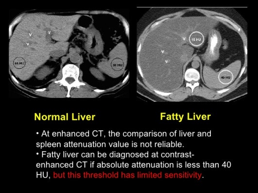 간 CT(liver CT) : 네이버 블로그
