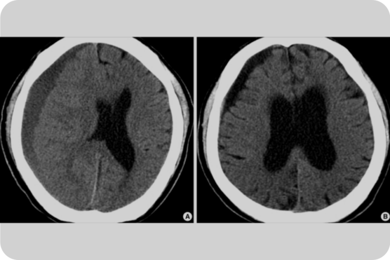 의학용어 CVA, EDH, SDH, SAH 부위마다 다른 뇌혈관 질환 용어 : 네이버 블로그