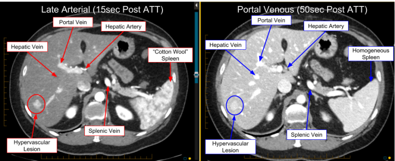 간 CT(liver CT) : 네이버 블로그