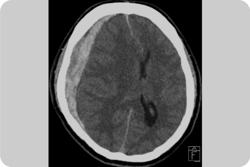 의학용어 CVA, EDH, SDH, SAH 부위마다 다른 뇌혈관 질환 용어 : 네이버 블로그