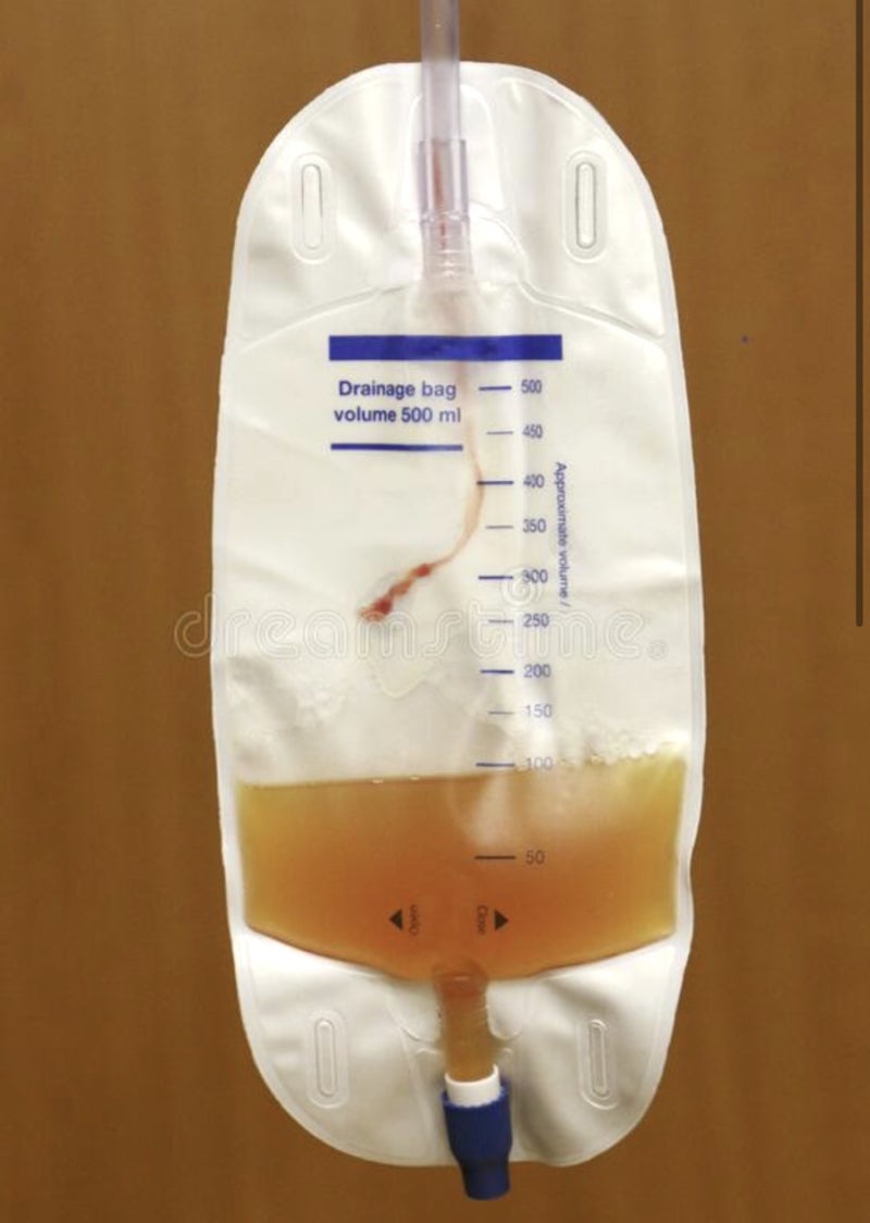 [의학용어] Serous, Sanguineous, chyle, turbid 등등 배액관 및 배액양상 쉽게보기 : 네이버 블로그