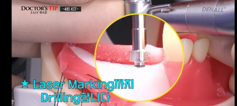 [덴올] 485kit & one 485 kit - 김경원 원장님 : 네이버 블로그