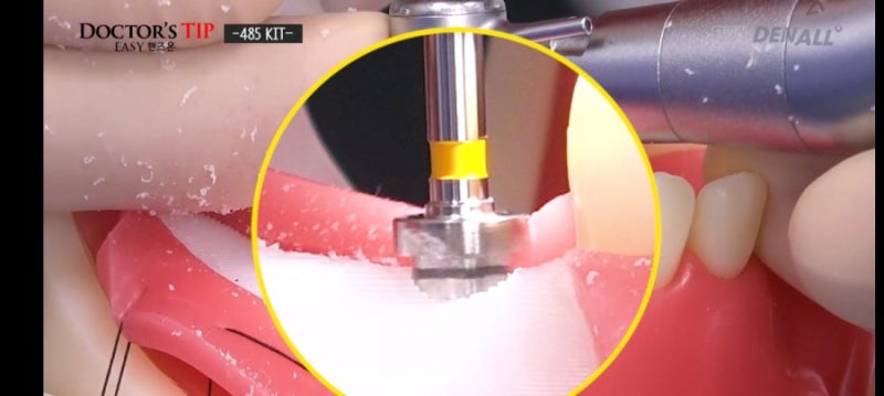 [덴올] 485kit & one 485 kit - 김경원 원장님 : 네이버 블로그