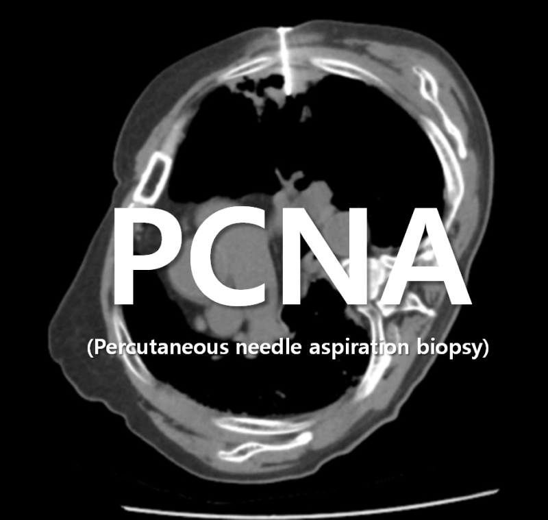PCNB(Percutanous needle aspiration biopsy) 경피적 세침 흡인 폐생검 : 네이버 블로그