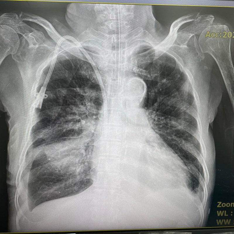 쭈이와 간호공부:) C-line, PICC, HD cath 각종 카테터 종류와 간호 : 네이버 블로그