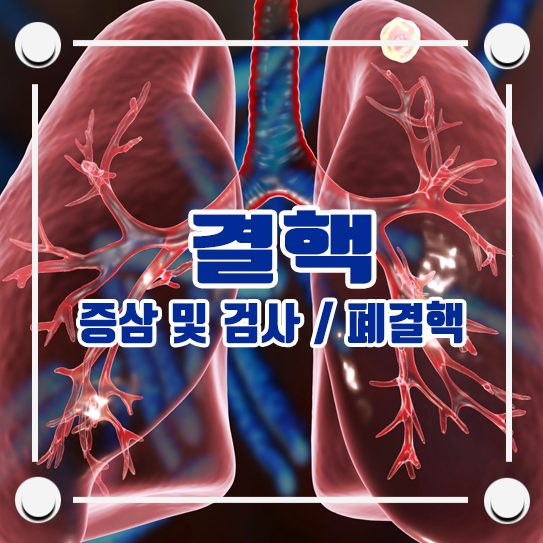 결핵 증상 및 잠복결핵 검사 방법 폐결핵 전염 네이버 블로그