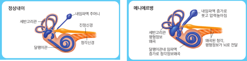 메니에르병 2 메니에르 증후군 원인 증상 검사 치료 예후경과 네이버 블로그