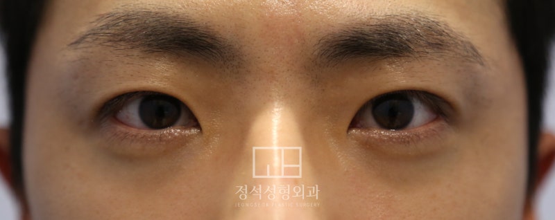 정석성형외과 케이스리뷰 1 심한 안검하수 환자에서 절개눈매교정 후 쌍꺼풀 풀려서 비절개눈매교정으로 눈재수술 진행한 사례