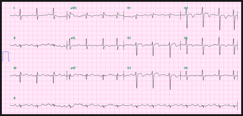 Wellens syndrome (웰렌 증후군) : 네이버 블로그
