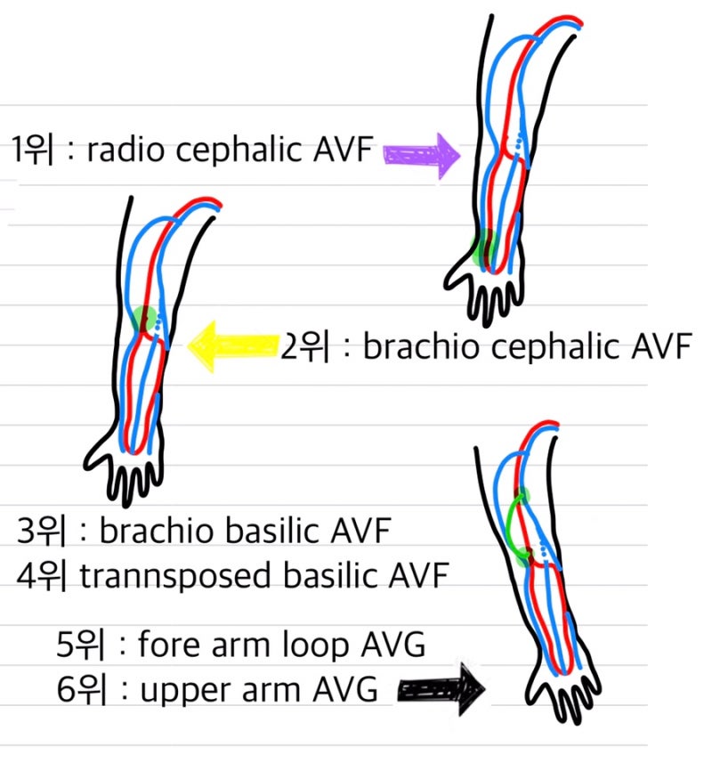 [투석혈관 종류] 동정맥루 생성과 구조, AVF, AVG : 네이버 블로그
