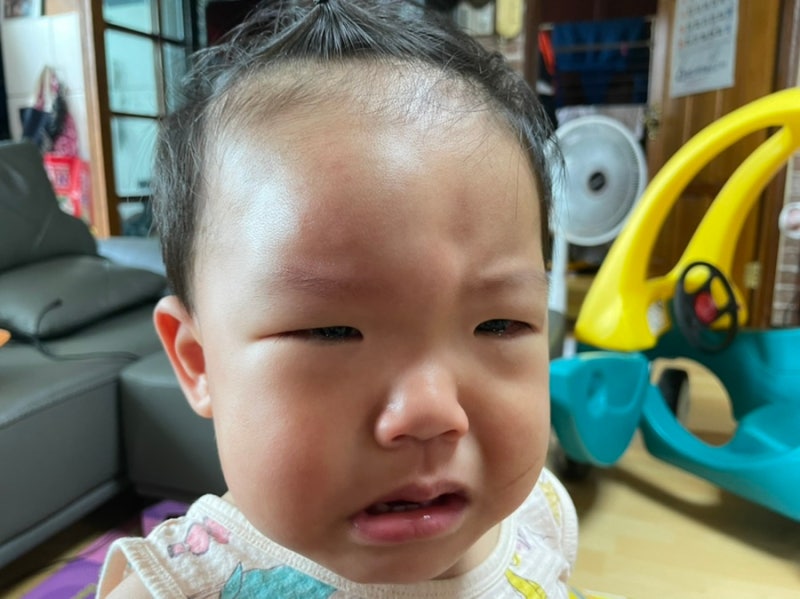 아기 모기물렸을때 리도맥스연고 냉찜질메디폼열패치 결국 병원 리얼후기 네이버 블로그