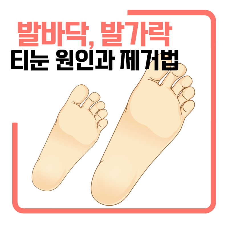 티눈 원인과 증상 발바닥과 발가락 티눈 제거법은 있나 네이버 블로그
