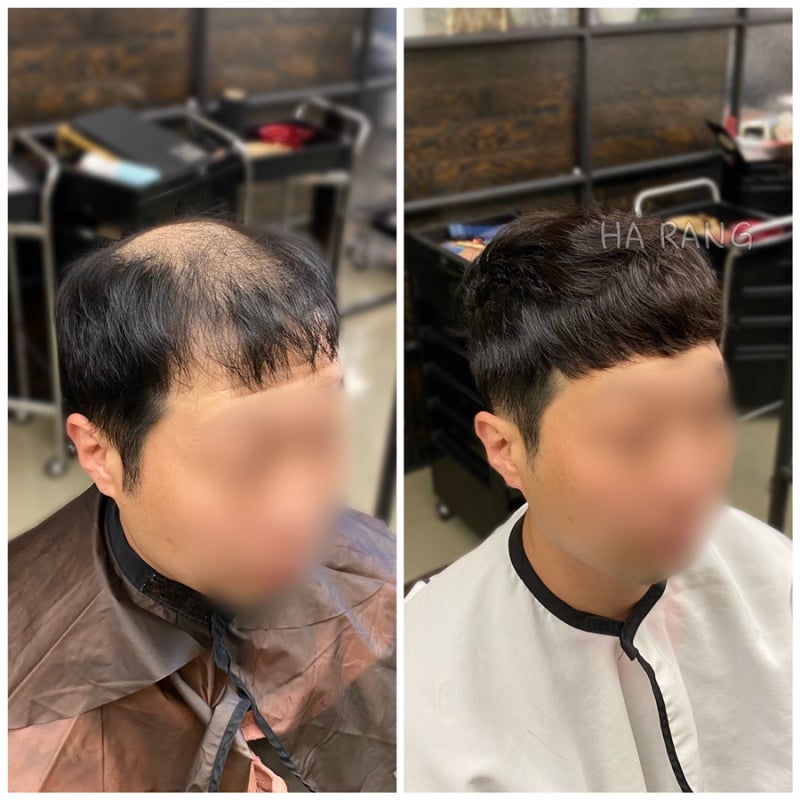 남자 증모술 유전탈모 정수리탈모고민 남자 가발 No 붙임머리로 고민해결 네이버 블로그