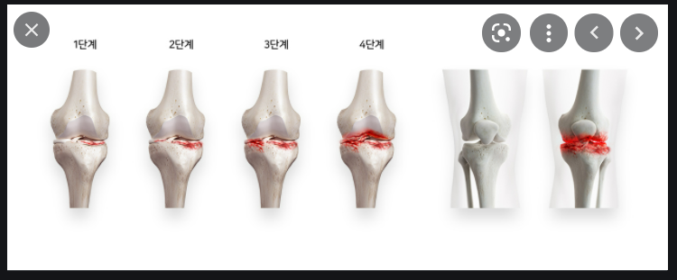 K-L grade(kellgren-Lawrence grading scale) : 네이버 블로그