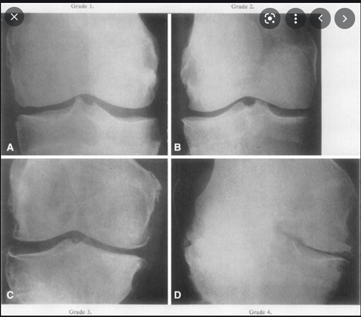 K-L grade(kellgren-Lawrence grading scale) : 네이버 블로그