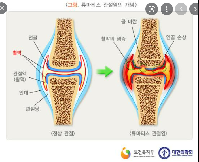 K-L grade(kellgren-Lawrence grading scale) : 네이버 블로그