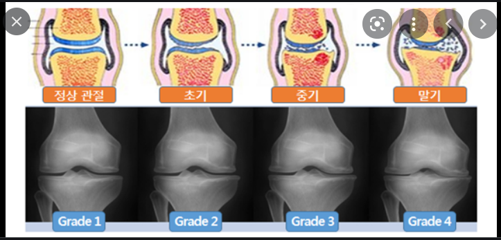 K-L grade(kellgren-Lawrence grading scale) : 네이버 블로그