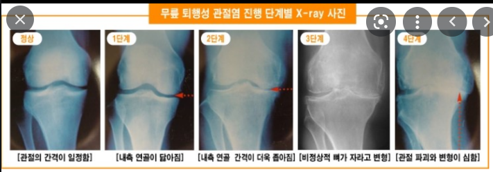 K-L grade(kellgren-Lawrence grading scale) : 네이버 블로그