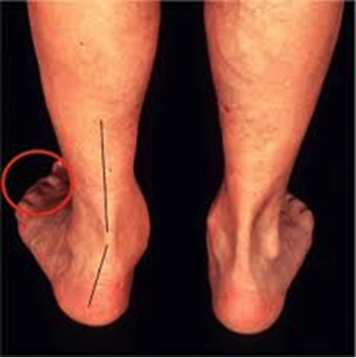 선천적 평발(구조적-강직성), 후천적 평발(기능적-유연성) 구분 검사 방법 : 네이버 블로그