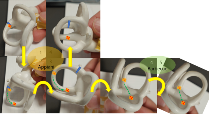 [BPPV][Topic] Gufoni(Appiani) Maneuver의 합리적인 실시 방법에 대한 고민 1. 이론 편 : 네이버 블로그