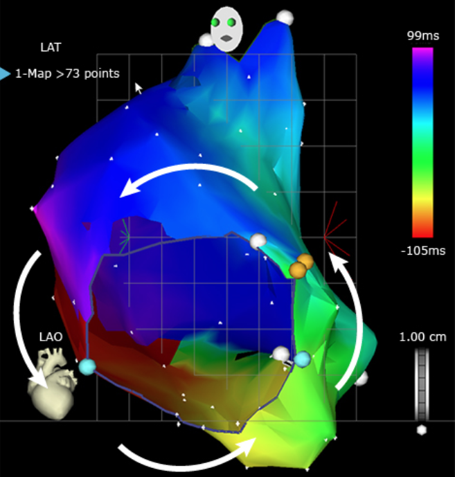 심방조동 : Typical atrial flutter (counterclockwise/clockwise circuit ...