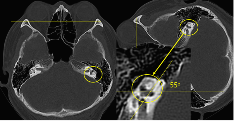 [BPPV][Topic] Barbecue Maneuver 단계마다 안진이 소실을 기다려야 하는지에 대한 고민 및, 새로운 ...