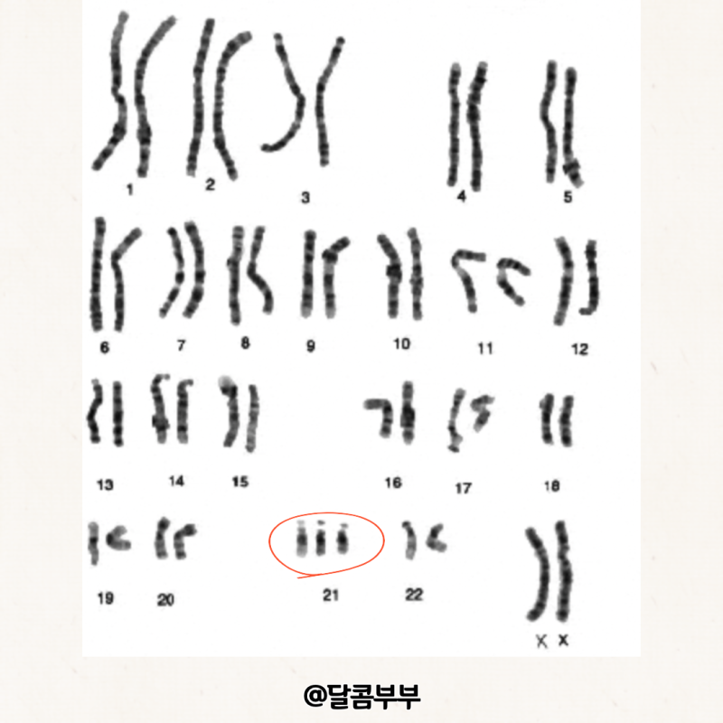 다운증후군 원인 증상 및 얼굴 특징 수명 검사 치료 네이버 블로그