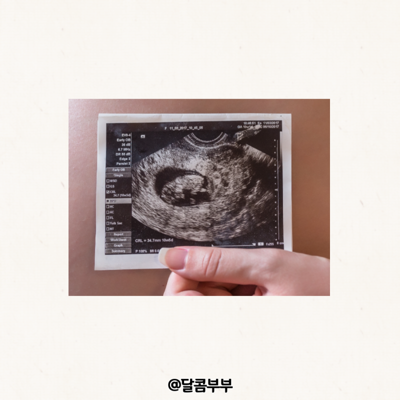 다운증후군 원인 증상 및 얼굴 특징 수명 검사 치료 네이버 블로그