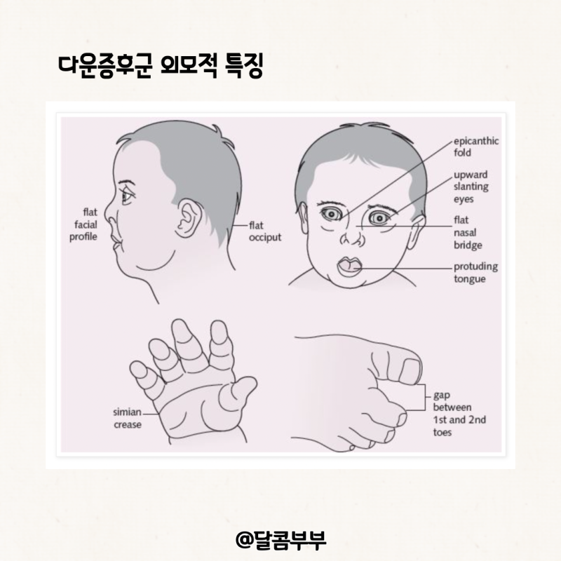 다운증후군 원인 증상 및 얼굴 특징 수명 검사 치료 네이버 블로그
