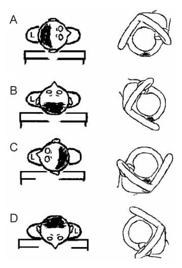 [BPPV][Topic] Barbecue Maneuver 단계마다 안진이 소실을 기다려야 하는지에 대한 고민 및, 새로운 ...