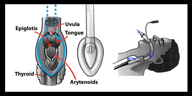 의학용어 LMA (Laryngeal mask airway), I-GEL : 네이버 블로그