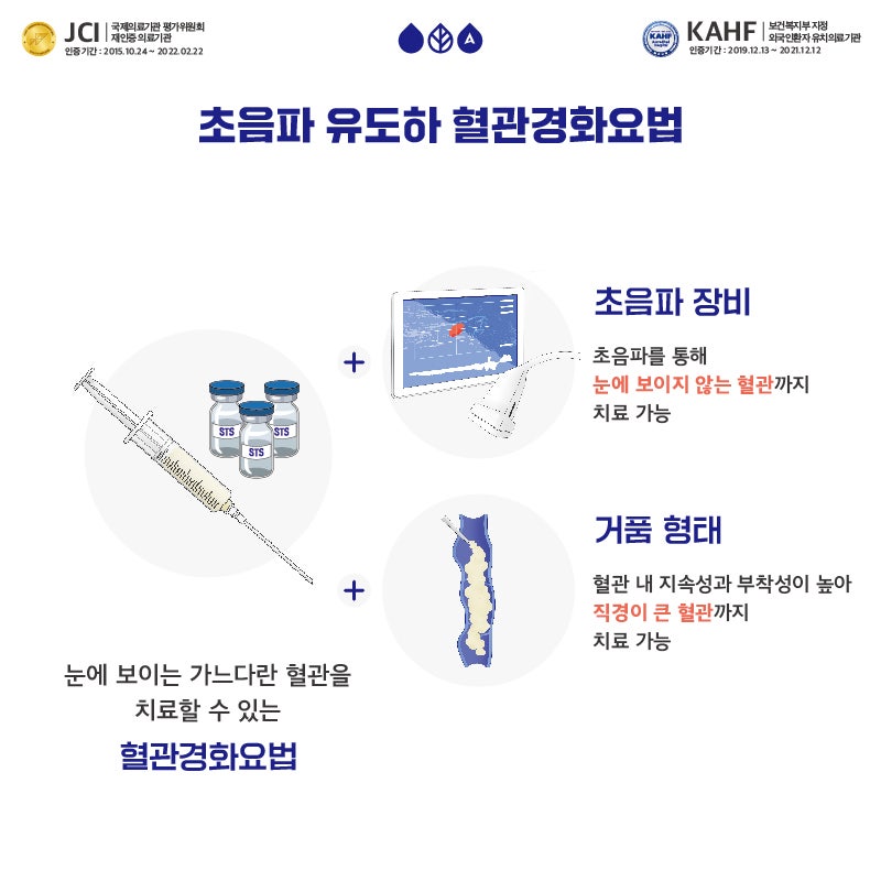 하지정맥류 주사치료혈관경화요법의 발달 네이버 블로그