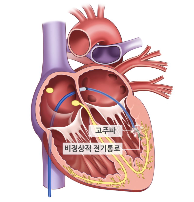 발작성 상심실성 빈맥 (Paroxysmal SupraVentricular Tachycardia, PSVT) : 네이버 블로그