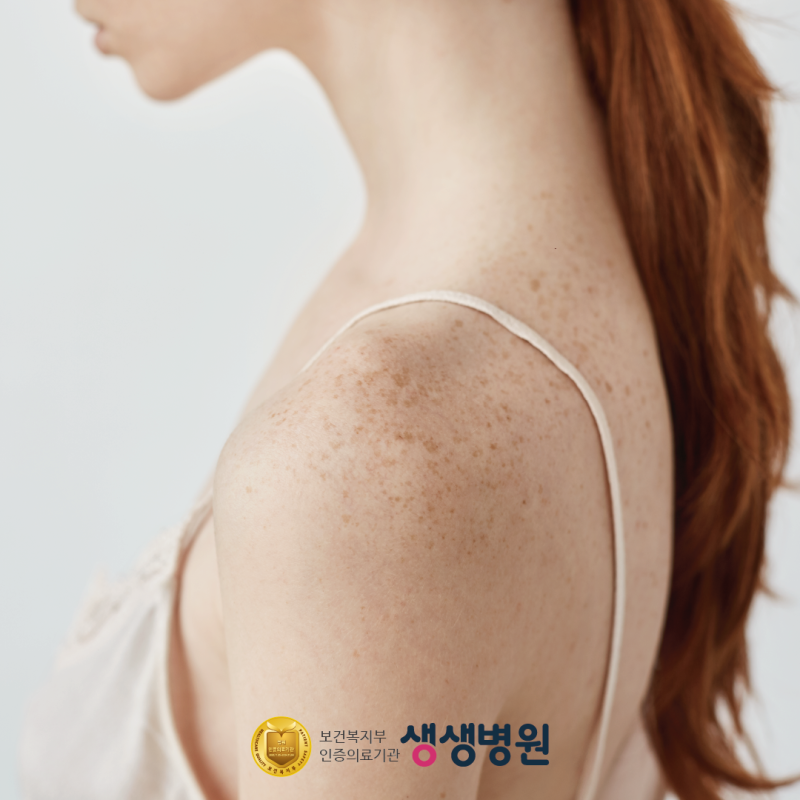 신경섬유종 밀크반점 밀크커피색 반점 유전병의 일종 신경섬유종증 네이버 블로그