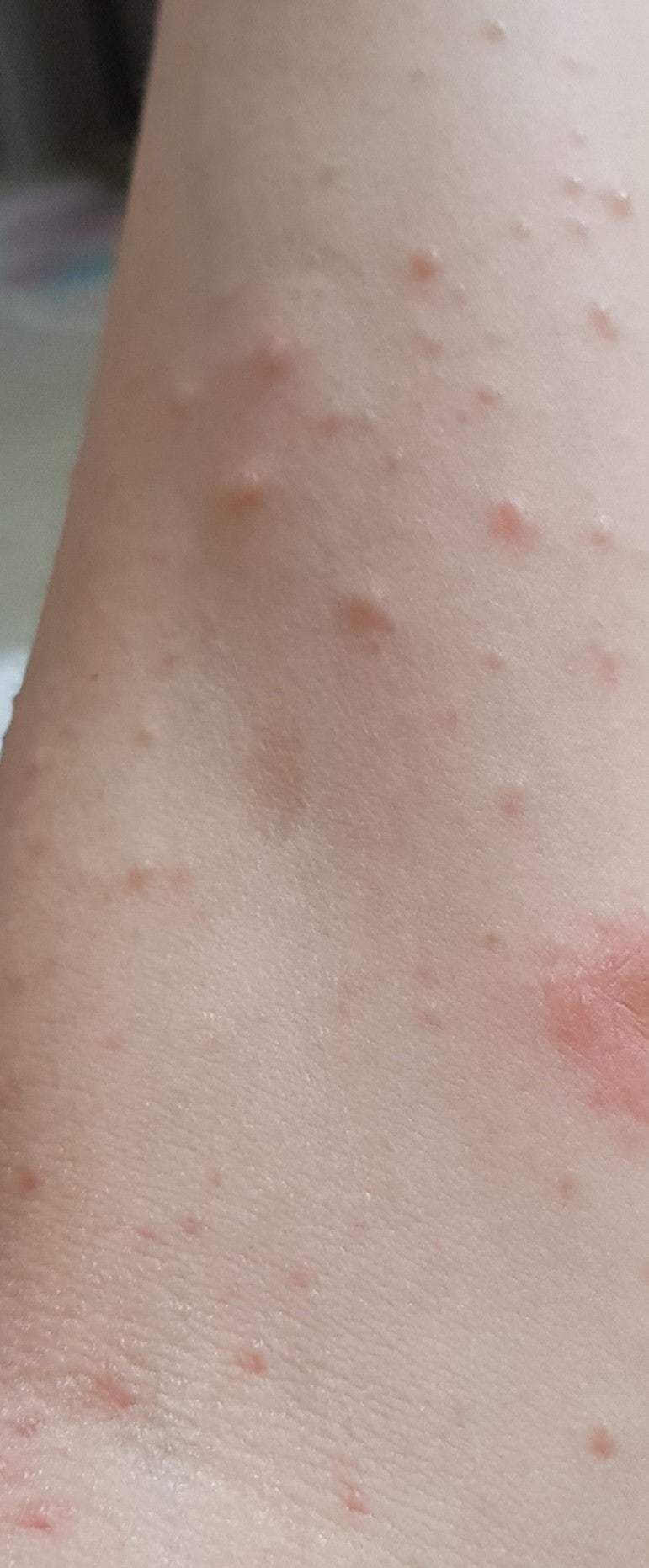 화이자 다형홍반 화이자 1차 부작용 화이자 부작용 발진 백신 부작용 다형홍반 백신 두드러기 네이버 블로그