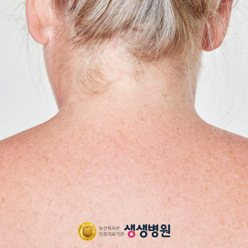신경섬유종 밀크반점 밀크커피색 반점 유전병의 일종 신경섬유종증 네이버 블로그