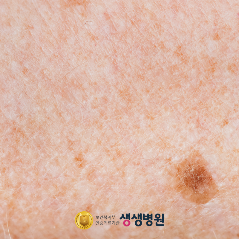 신경섬유종 밀크반점 밀크커피색 반점 유전병의 일종 신경섬유종증 네이버 블로그