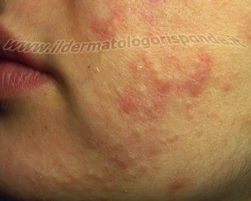 마스크 피부염 (mask dermatitis) (종류, 기전, 치료, 예방) : 네이버 블로그