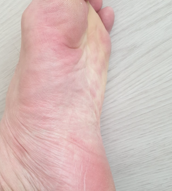 무좀 원인 증상 무좀균 엄지 새끼발톱 무좀 증상 발톱 치료 손톱 발가락 발바닥 뿌리는 무좀약 추천 네이버 블로그
