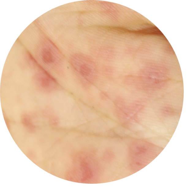 화이자·모더나 백신 접종 뒤 다형홍반 발생 다형홍반 Erythema Multiforme 이란 네이버 블로그