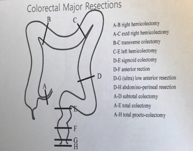 Laparoscopic exploration & Exploratory laparotomy GS hartmann op ...