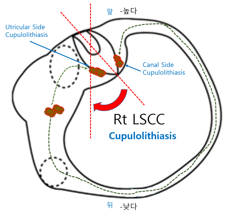 [기초교육] 수평세반고리관 이석증의 진단 과정 총정리 : 네이버 블로그