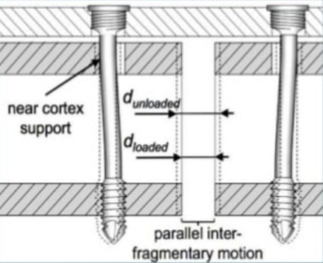 os수술 basic편 -screw에 대해 , reduction에 대해 , screw종류 , screw기능 , ORIF 아직 ...