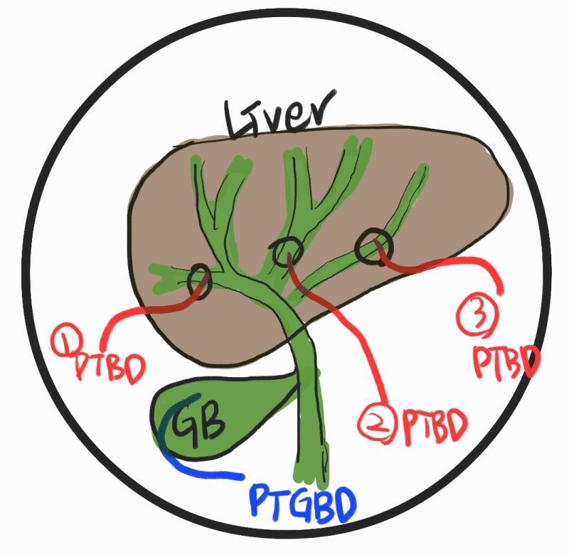 PTBD, PTGBD 정상양상과 비정상 양상 : 네이버 블로그