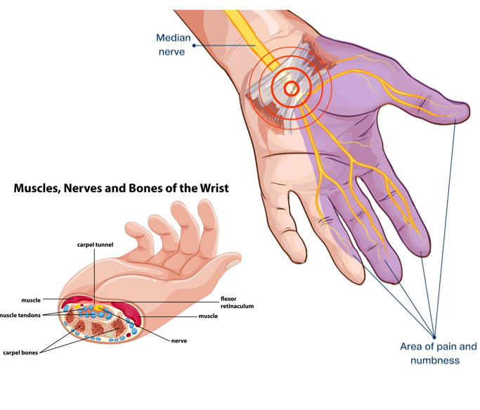 손끝저림손바닥저림 정중신경포착median Nerve Entrapment 천안아산 달천한의원 네이버 블로그