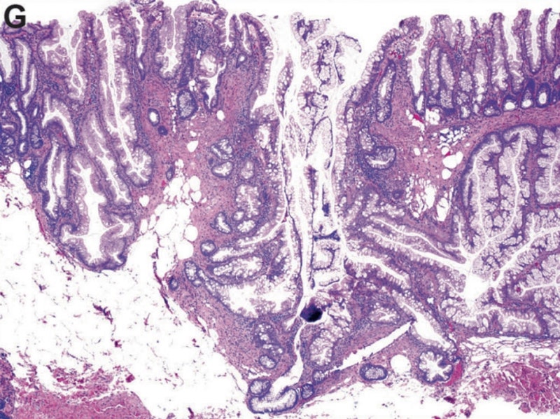 Colorectal serrated lesions and polyps, 용어 이해 ① : 네이버 블로그