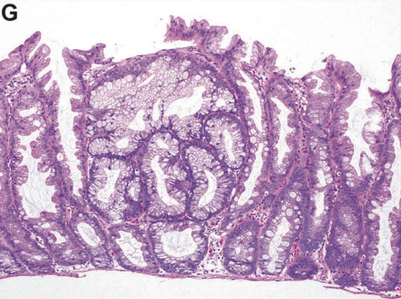 Colorectal serrated lesions and polyps, 용어 이해 ① : 네이버 블로그