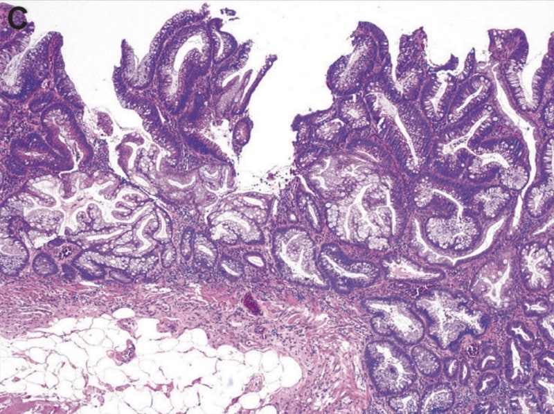 Colorectal serrated lesions and polyps, 용어 이해 ① : 네이버 블로그