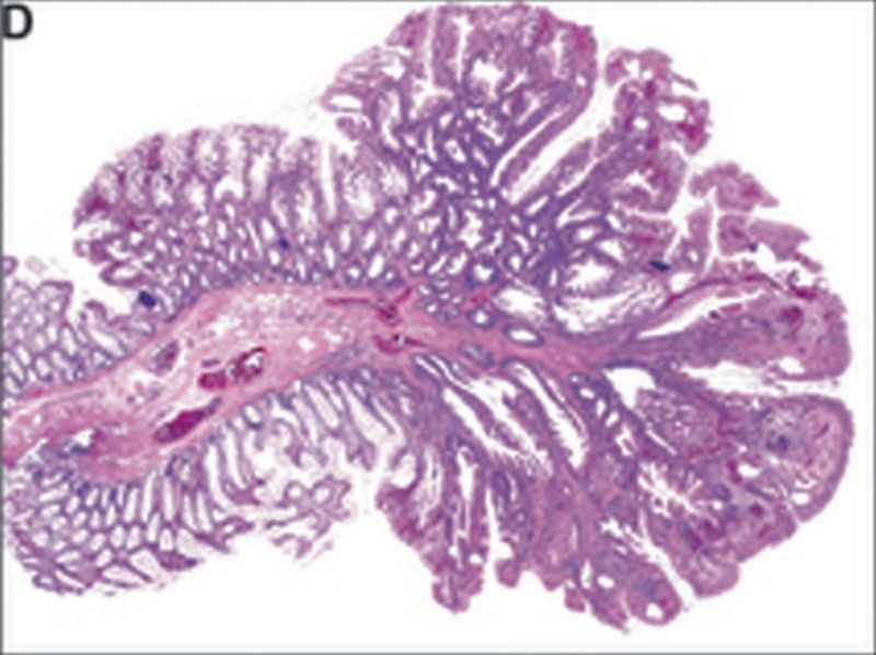 Colorectal serrated lesions and polyps, 용어 이해 ① : 네이버 블로그