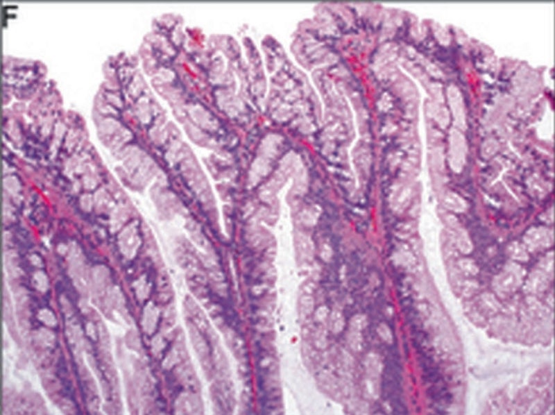 Colorectal serrated lesions and polyps, 용어 이해 ① : 네이버 블로그